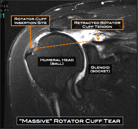 Massive Rotator Cuff Tear Cheaper Than Retail Price Buy Clothing